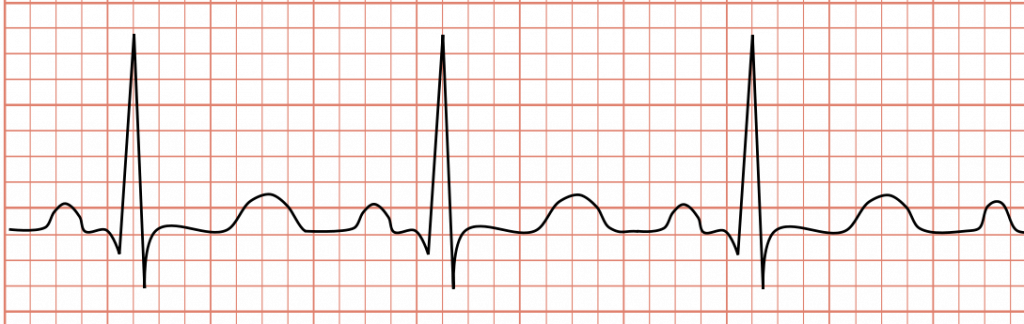 Tachycardia with a Pulse Algorithm | ACLS.com Resources