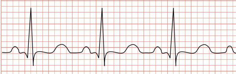 Tachycardia with a Pulse Algorithm | ACLS.com Resources